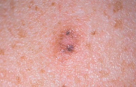Desmoplastic melanoma - Il Melanoma